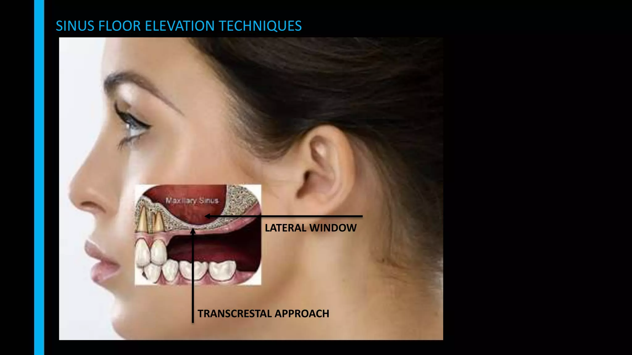 Maxillary sinus floor elevation | PPTX