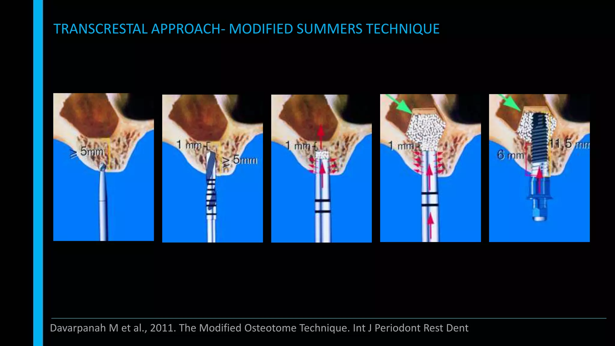 Maxillary sinus floor elevation | PPTX