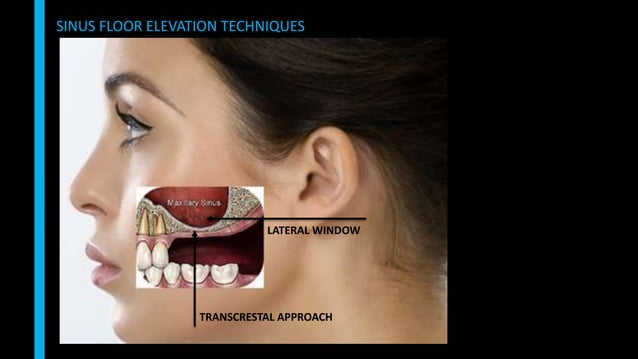 Maxillary sinus floor elevation | PPTX
