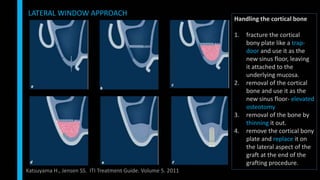 Maxillary sinus floor elevation | PPTX