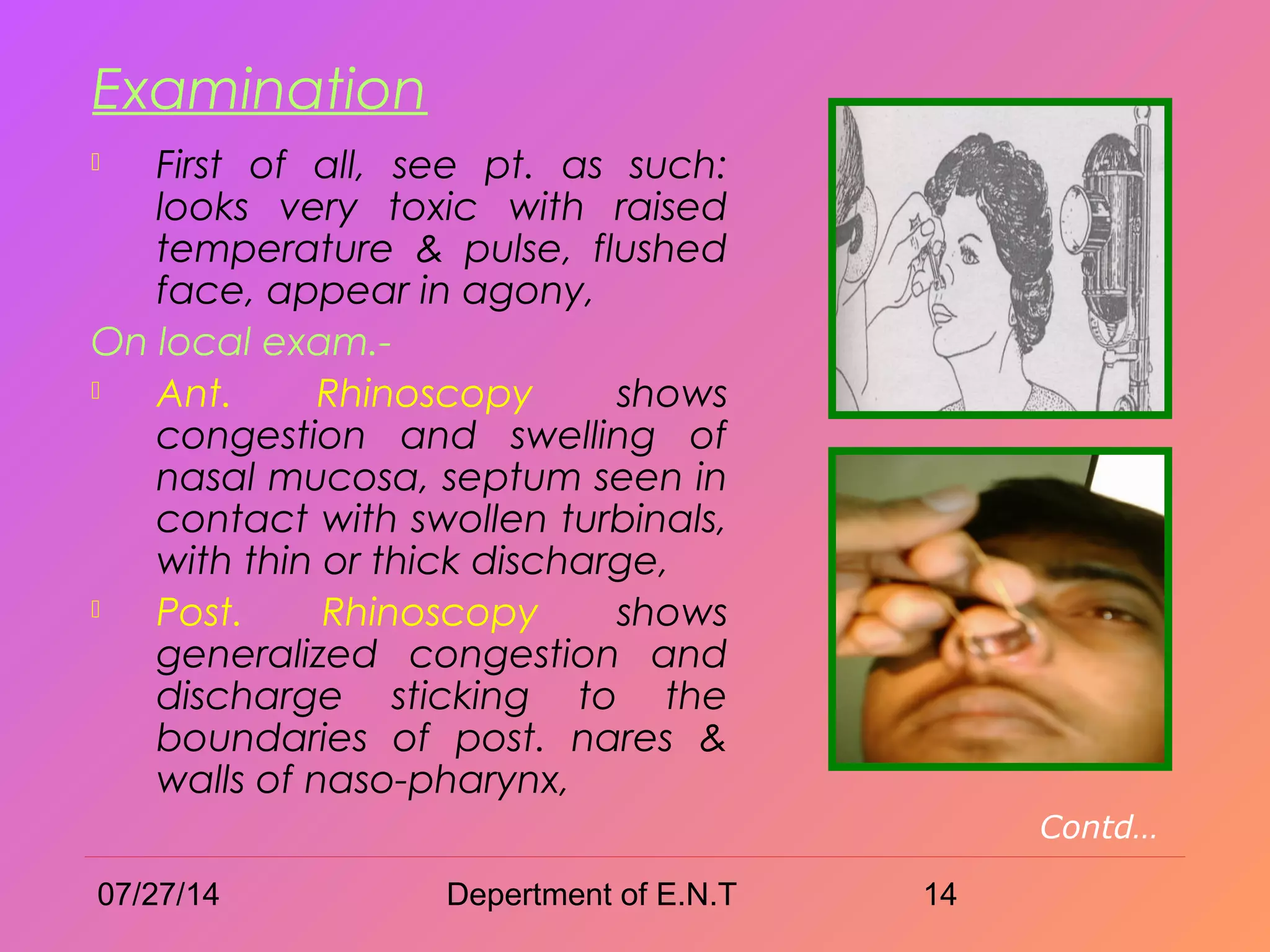 Maxillary sinusitis | PPT