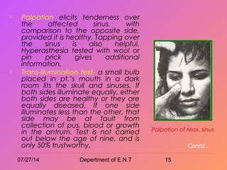 Maxillary sinusitis | PPT