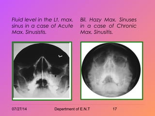 Maxillary sinusitis | PPT