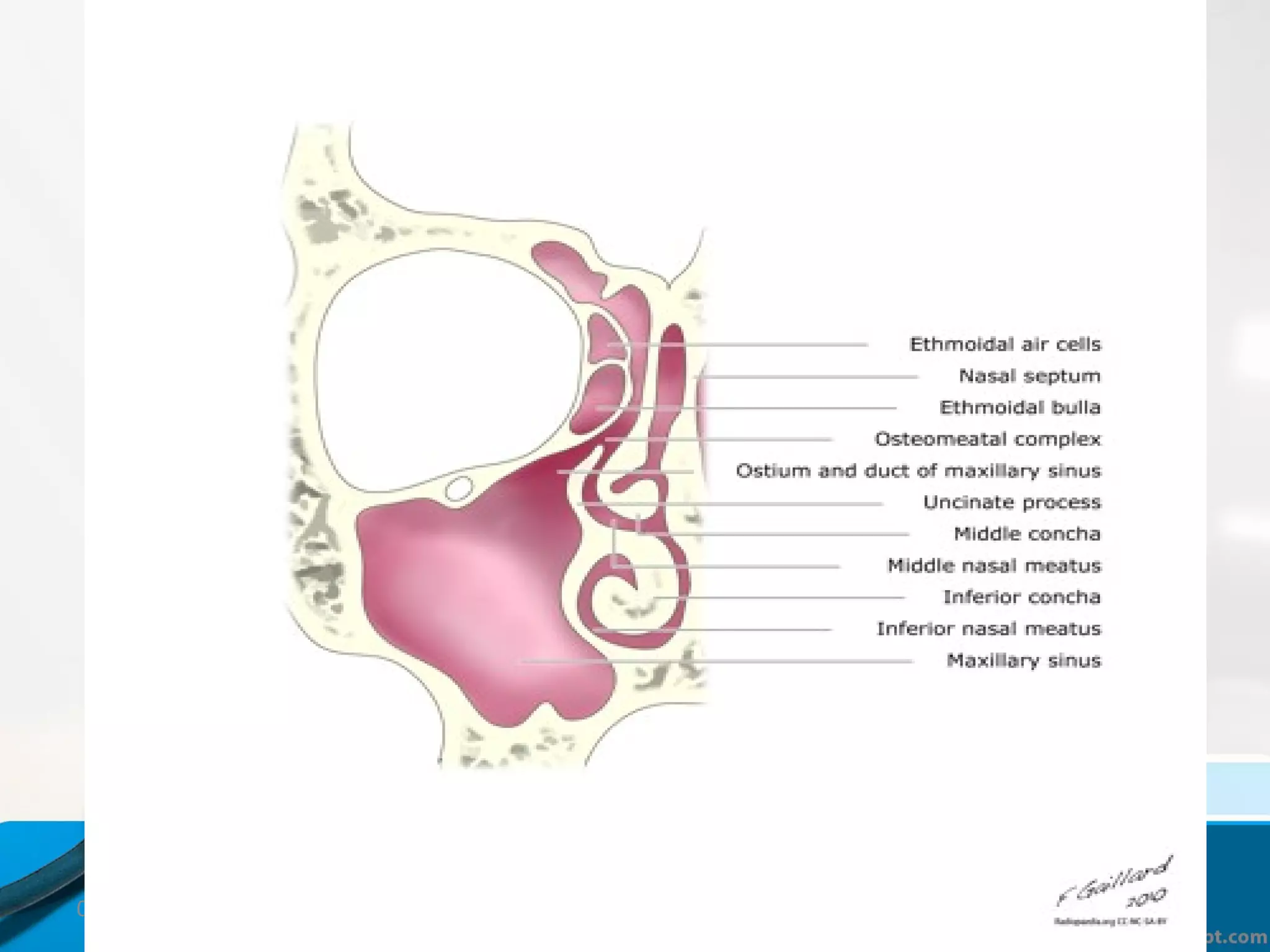 Maxillary sinusitis | PPT