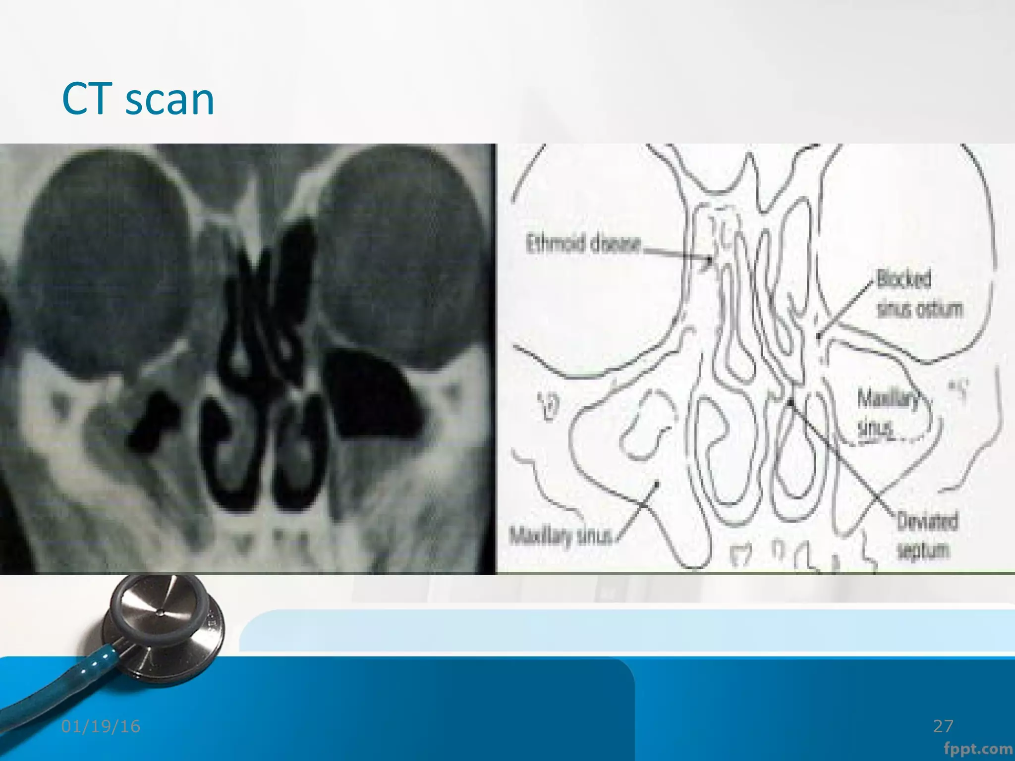 Maxillary sinusitis | PPT