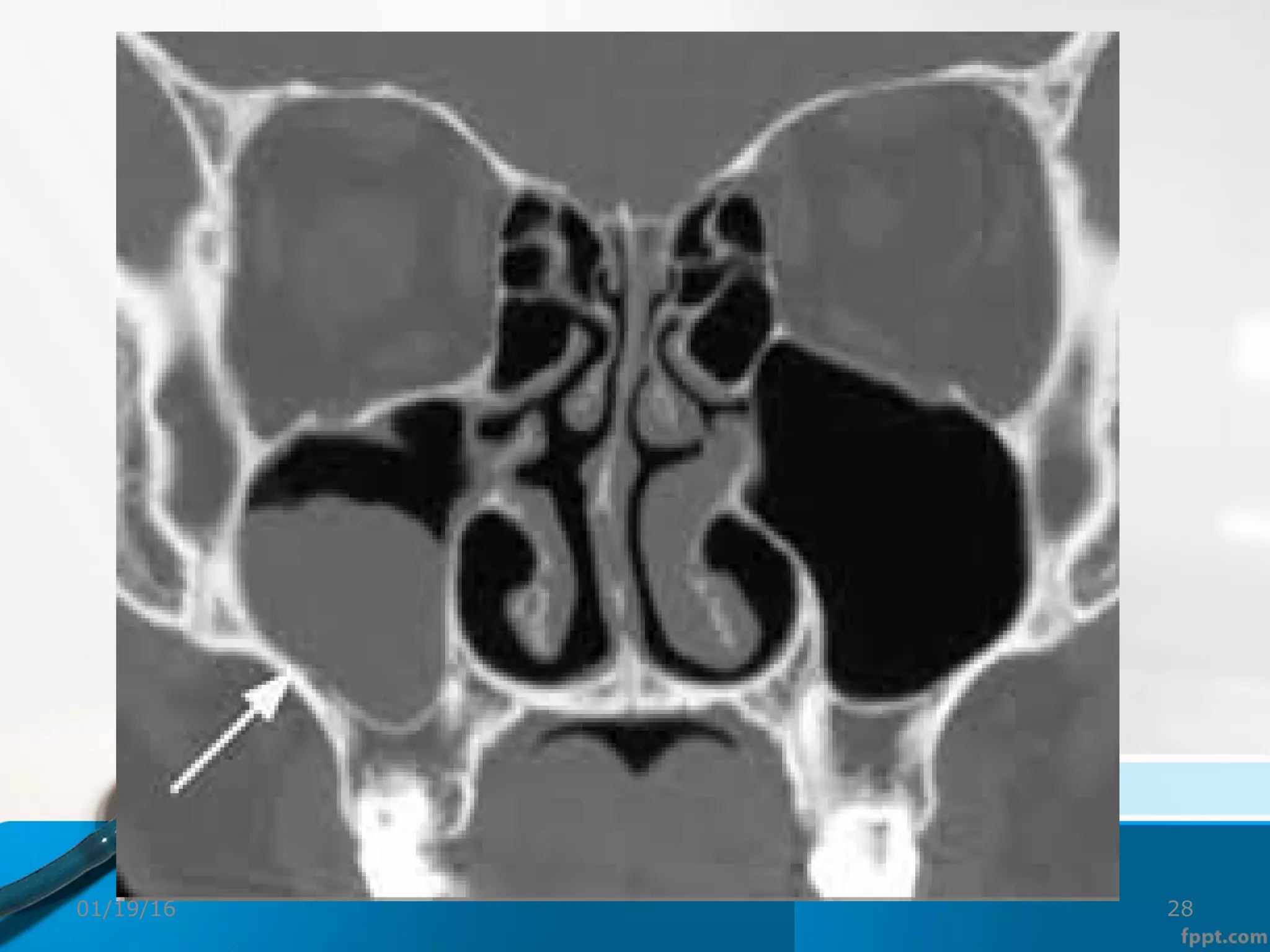 Maxillary sinusitis | PPT