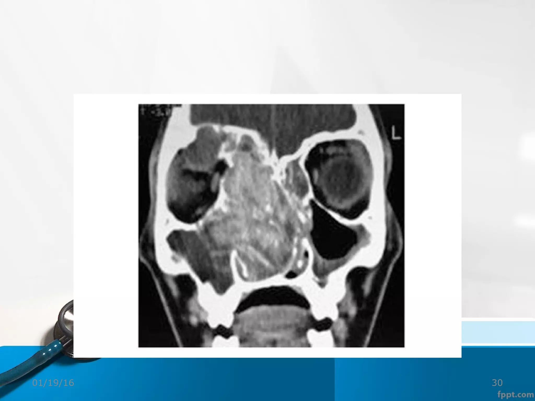 Maxillary sinusitis | PPT