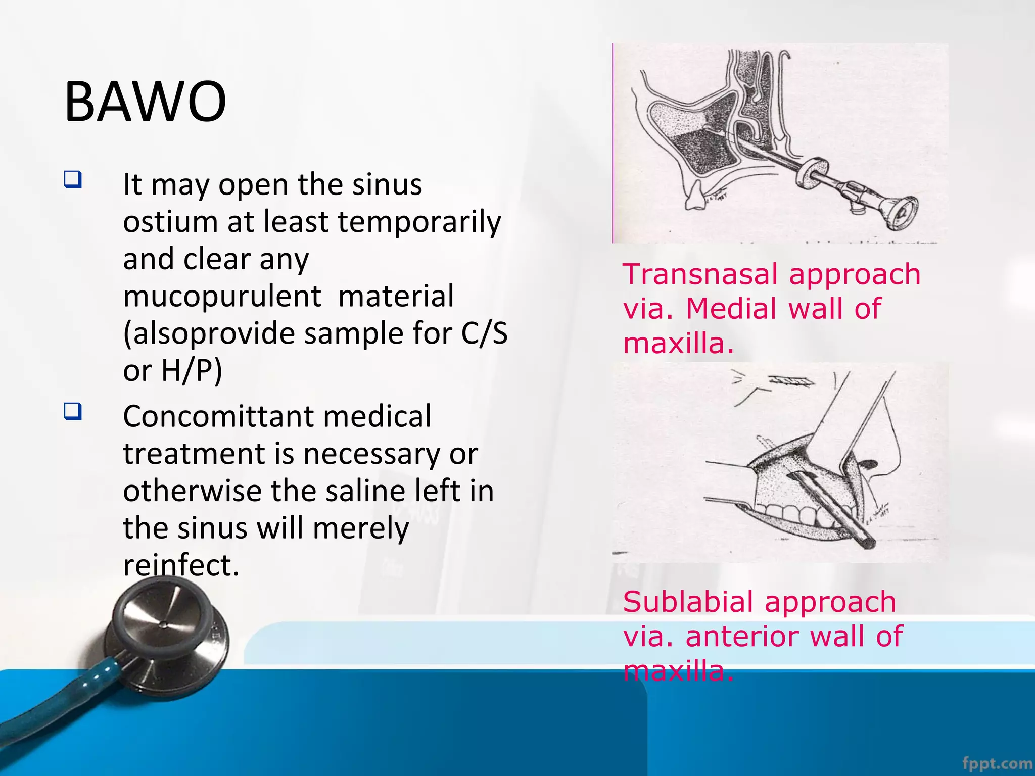 Maxillary sinusitis | PPT