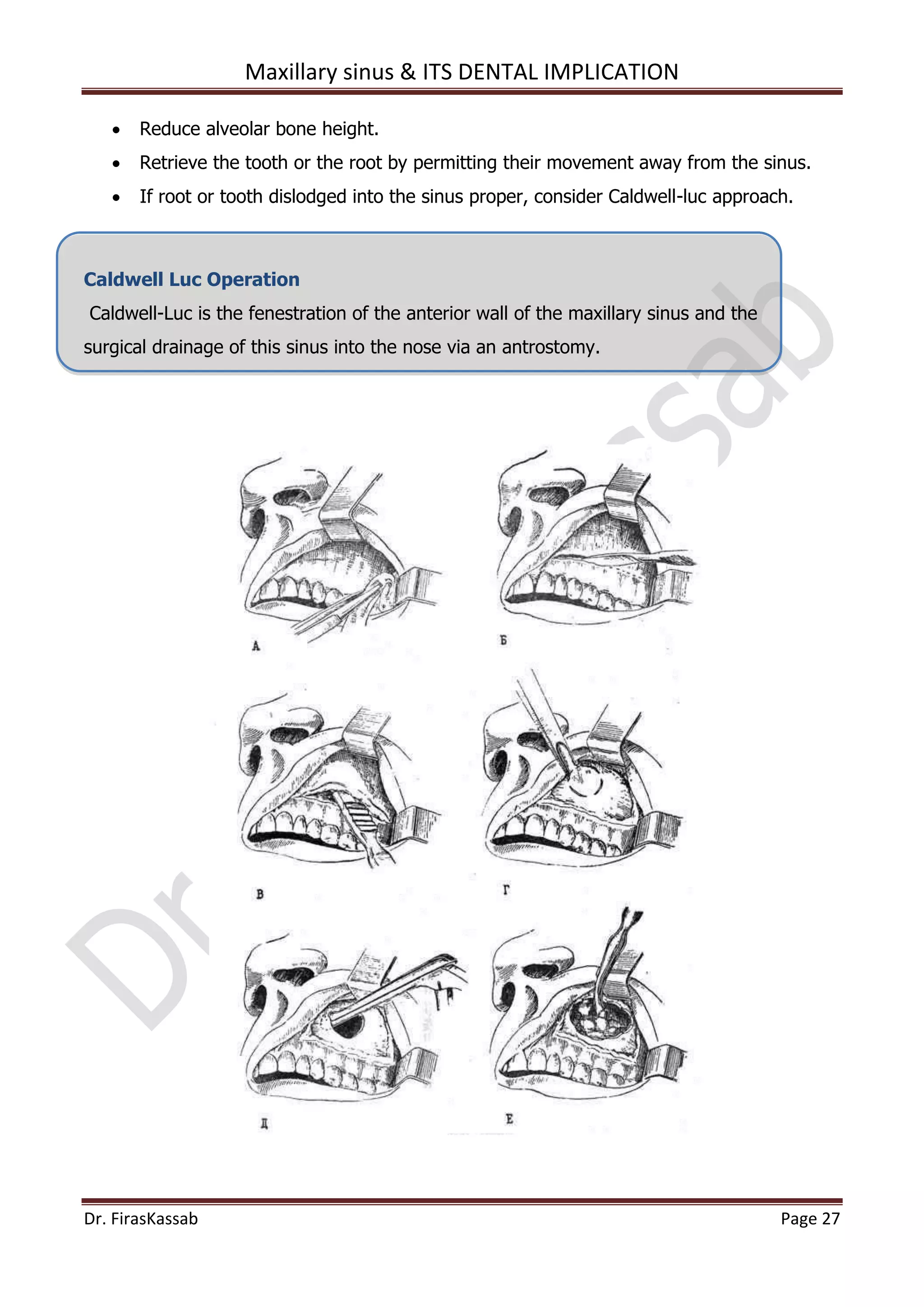 Maxillary sinus & its dental implication | PDF