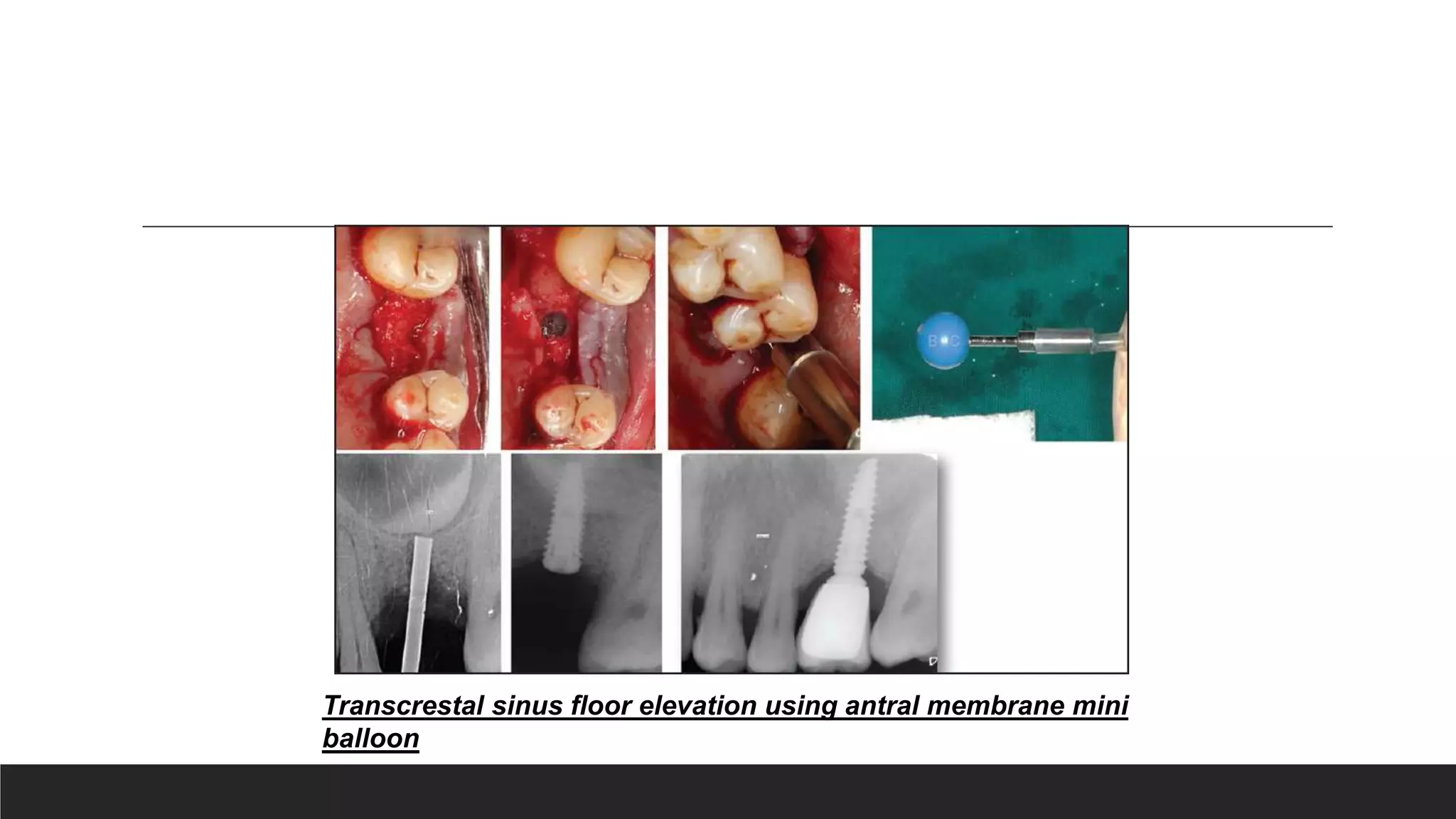 Maxillary sinus lift | PPTX