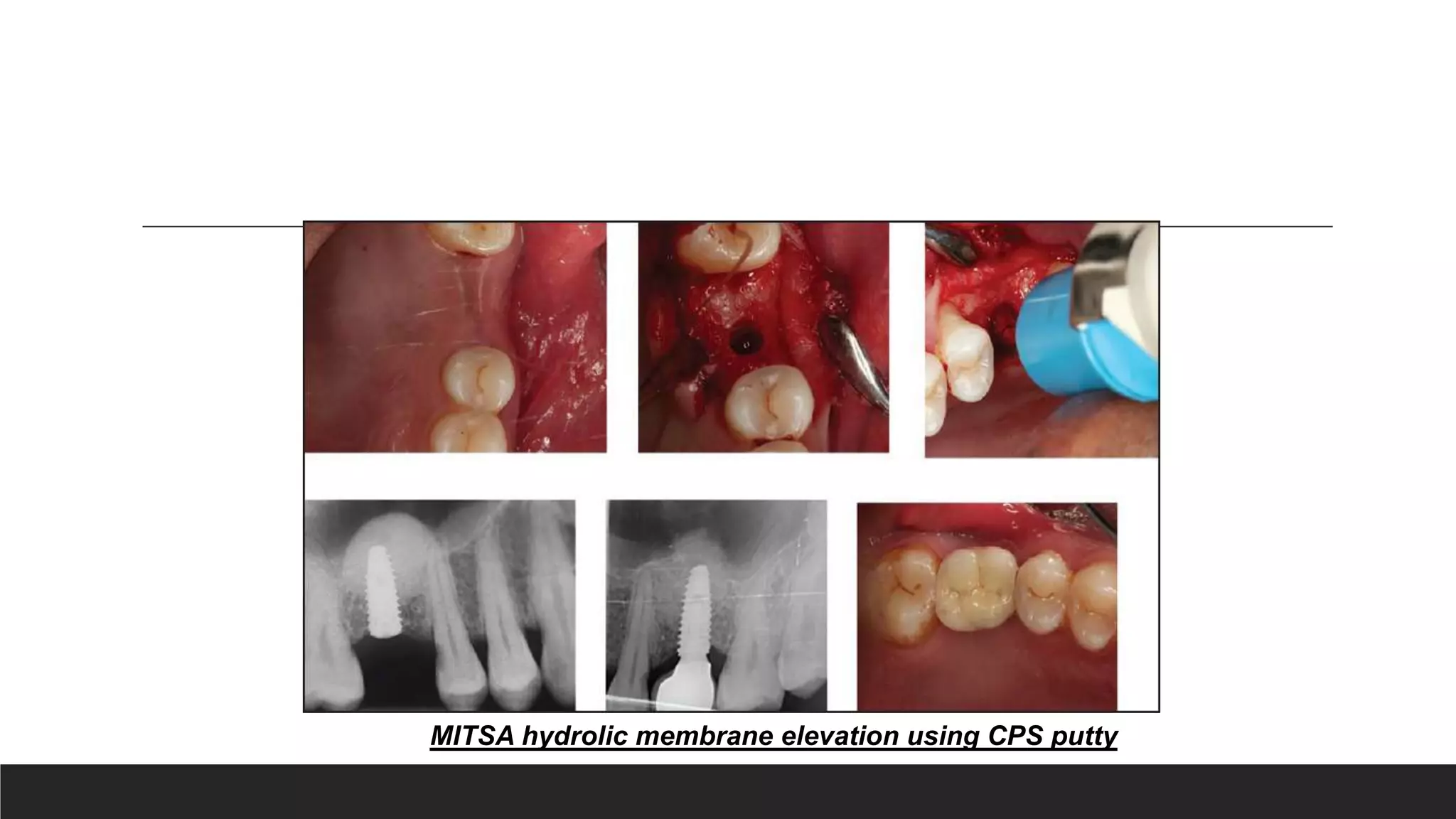 Maxillary sinus lift | PPTX
