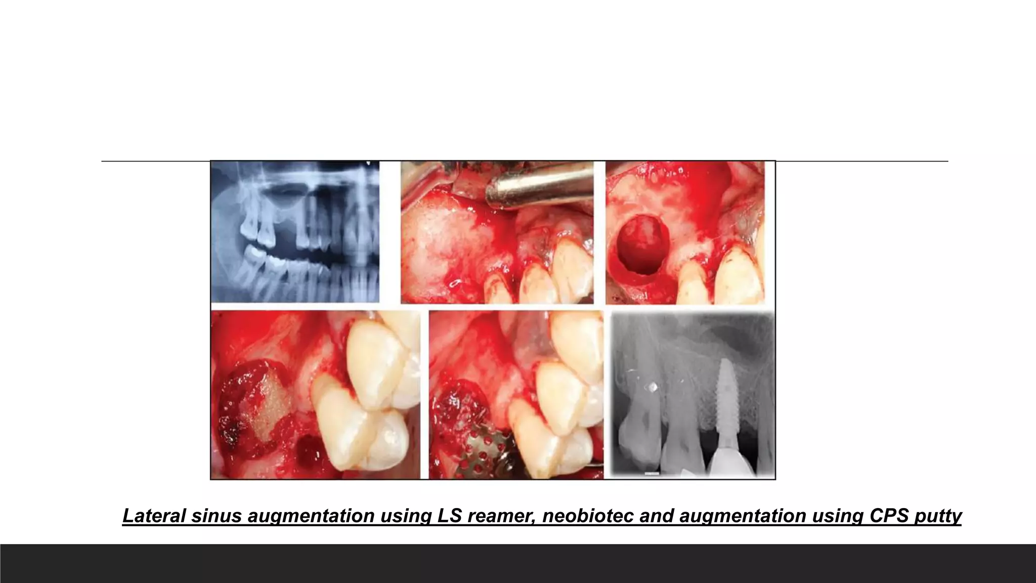 Maxillary sinus lift | PPTX