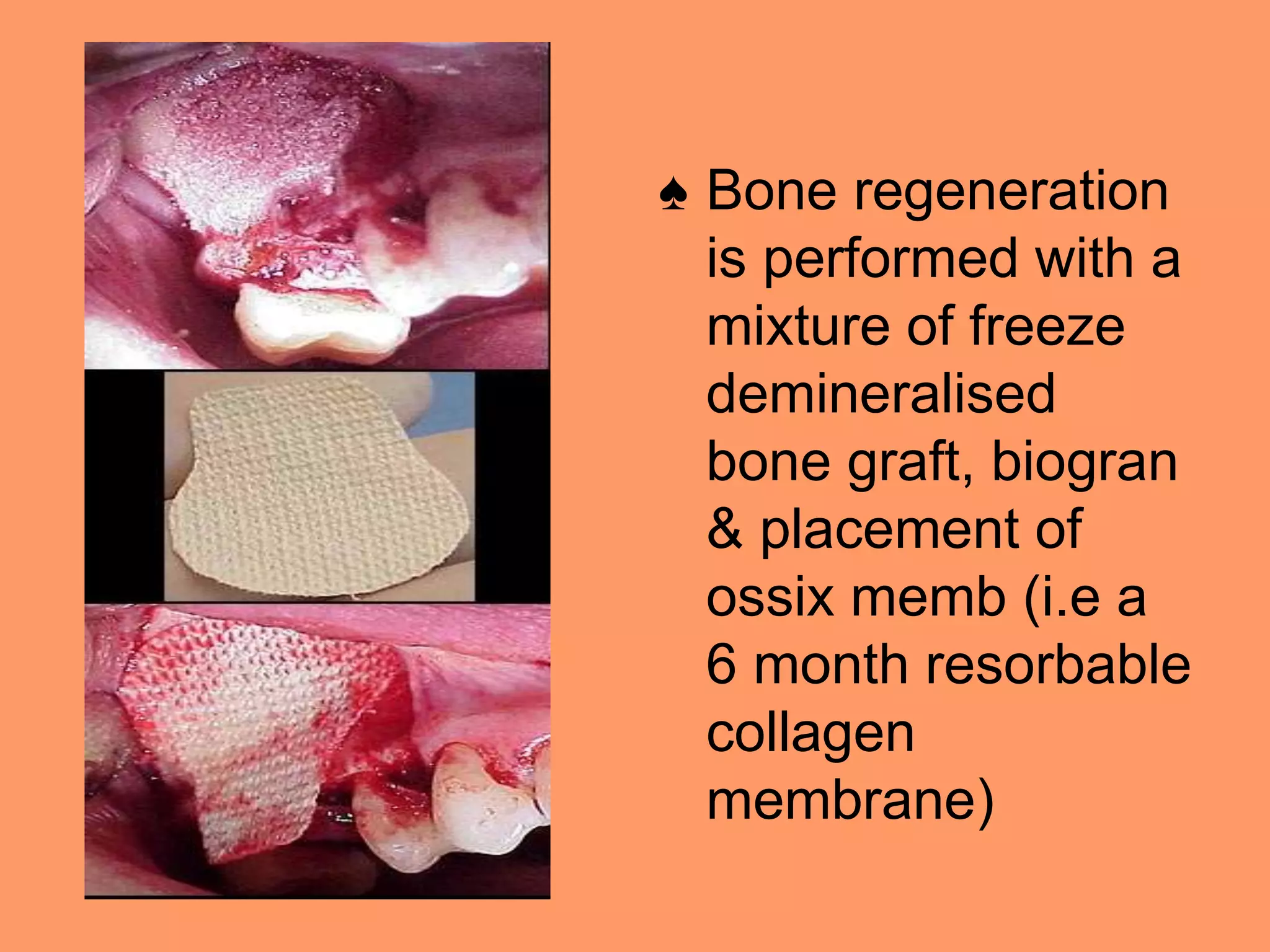 MAXILLARY SINUS LIFT PROCEDURES.ppt