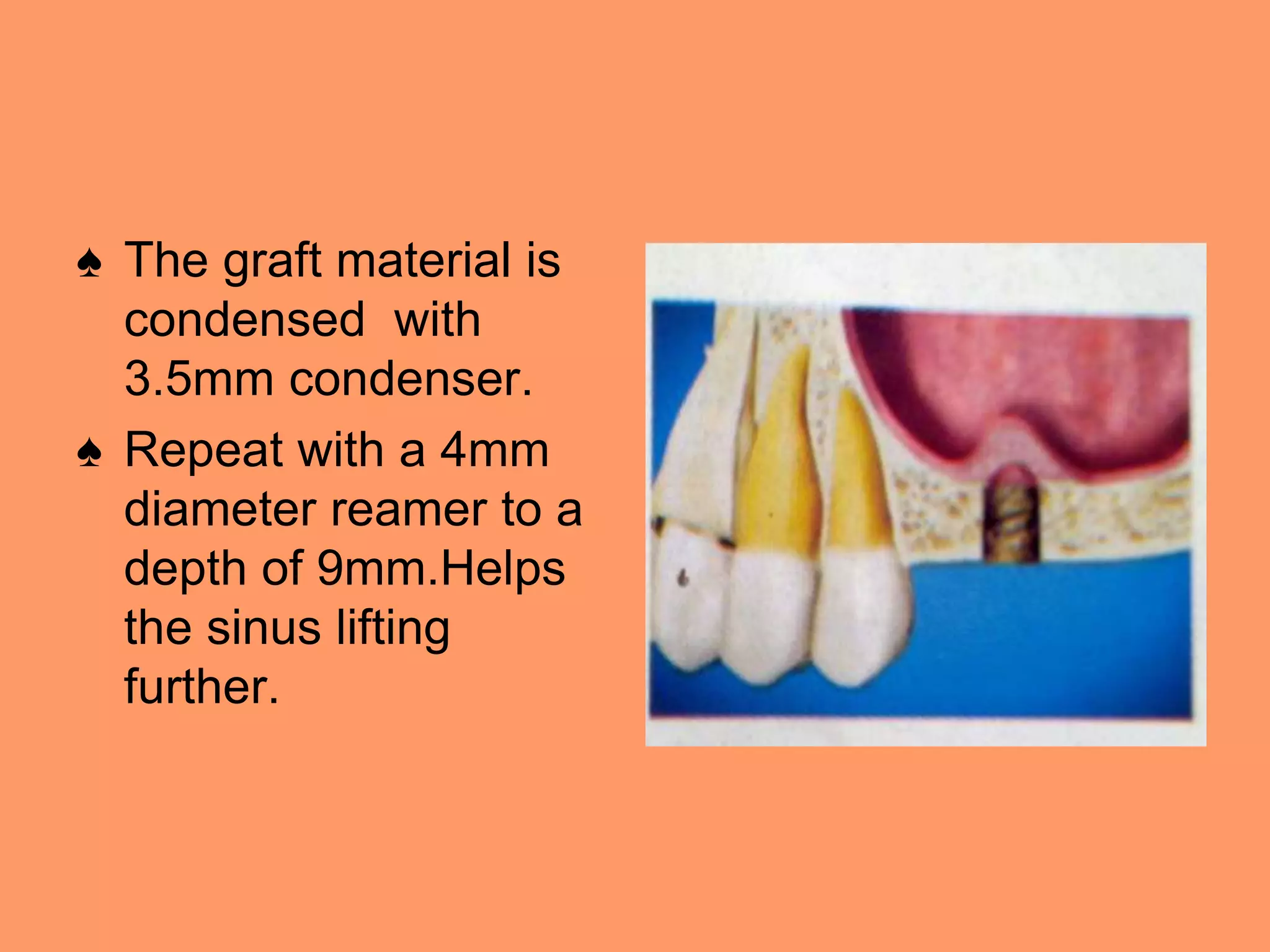 MAXILLARY SINUS LIFT PROCEDURES.ppt