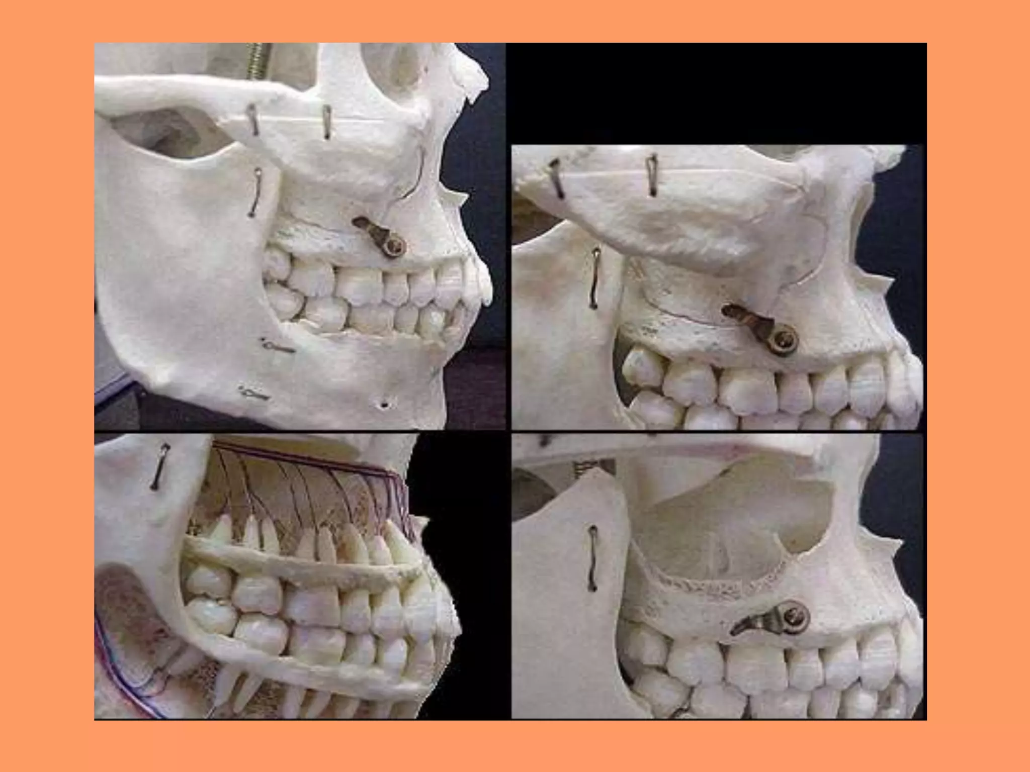 MAXILLARY SINUS LIFT PROCEDURES.ppt