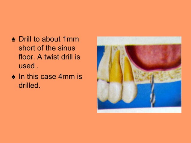 MAXILLARY SINUS LIFT PROCEDURES.ppt