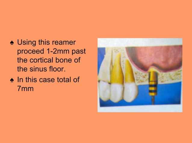MAXILLARY SINUS LIFT PROCEDURES.ppt