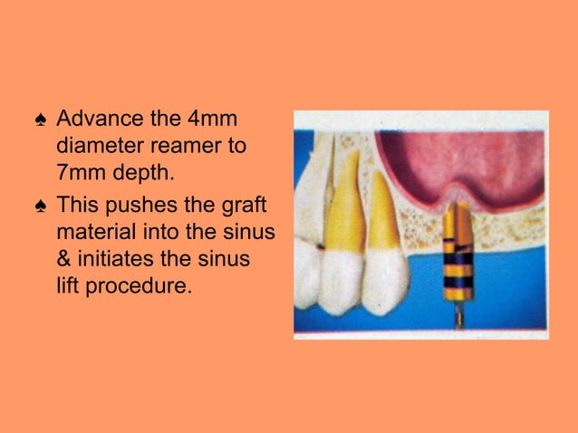 MAXILLARY SINUS LIFT PROCEDURES.ppt