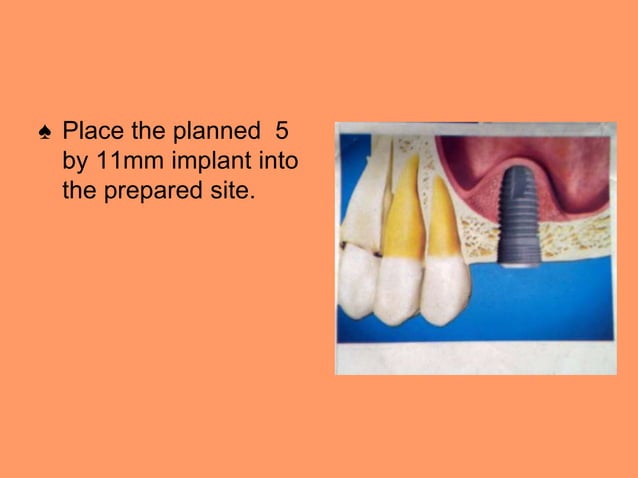 MAXILLARY SINUS LIFT PROCEDURES.ppt