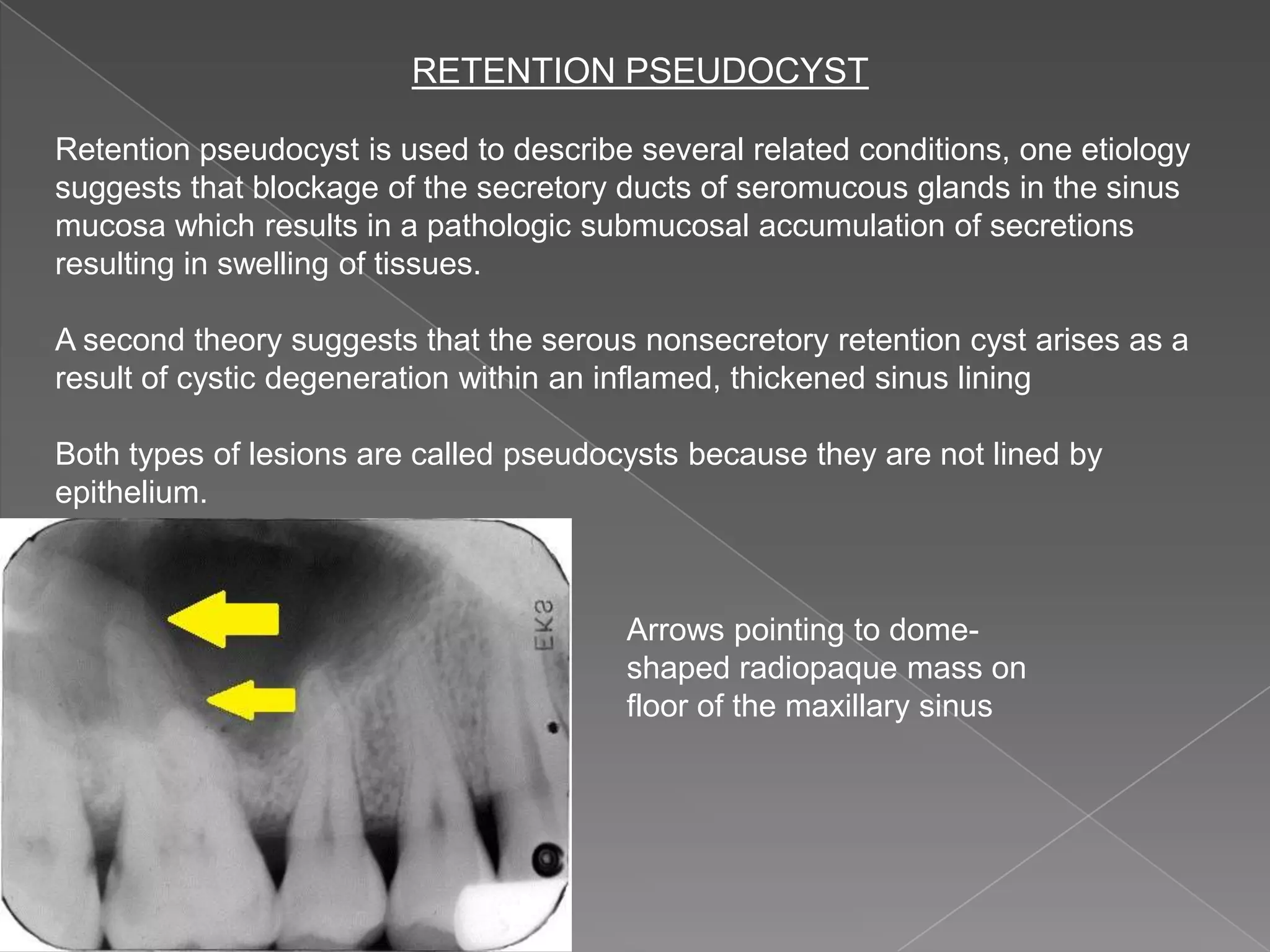 Maxillary sinus new | PPTX