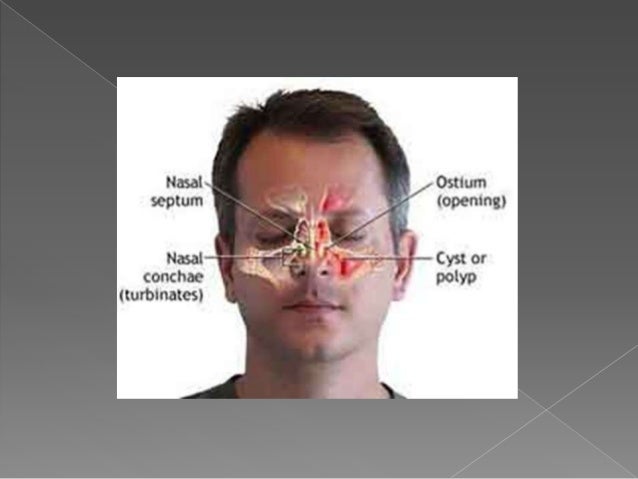 Maxillary Sinus Mucosal Thickening Treatment Quotes Viral Update