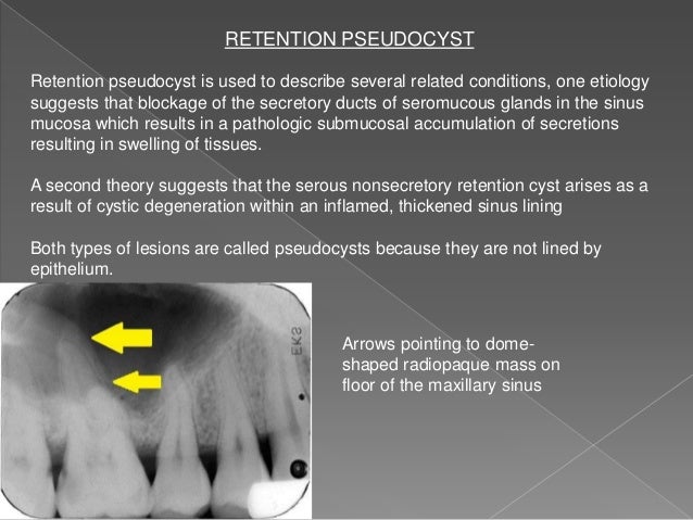 Maxillary sinus new