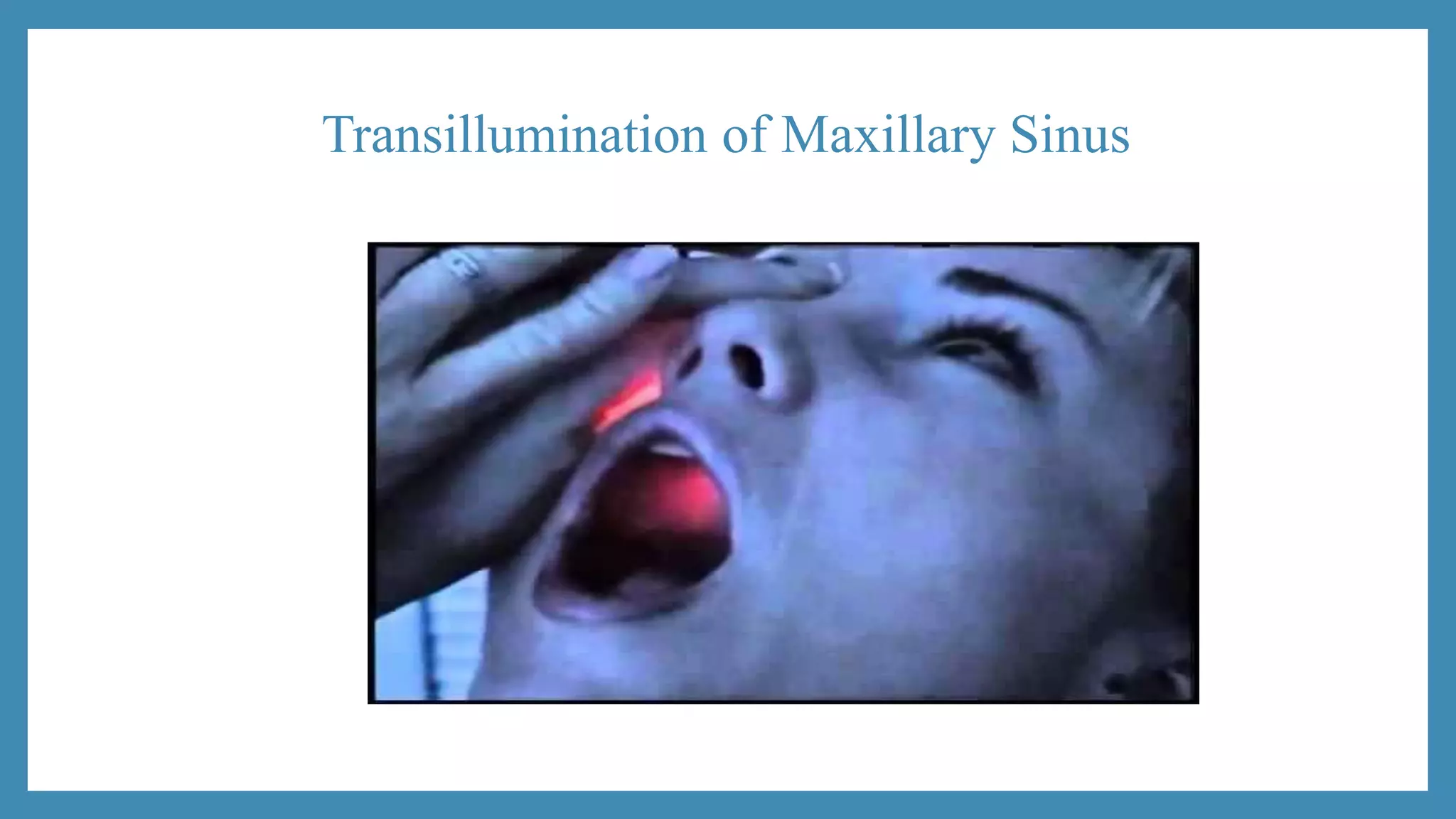 Maxillary sinus part 2 | PPTX