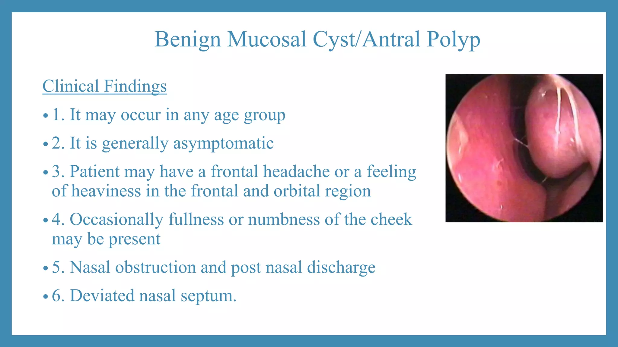 Maxillary sinus part 2 | PPTX