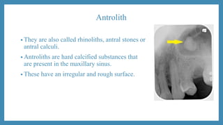 Maxillary sinus part 2 | PPT