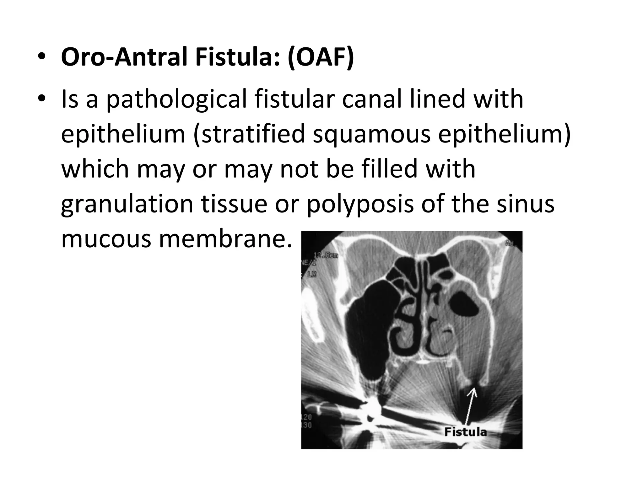 Maxillary sinus ppt | PPT