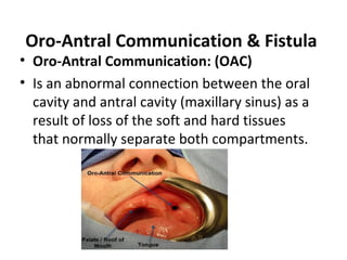 Maxillary sinus ppt | PPT