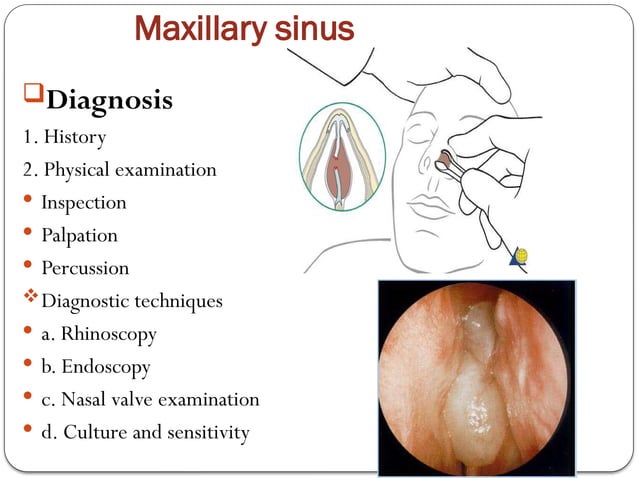 maxillarysinuspresentation-201208183440.pptx