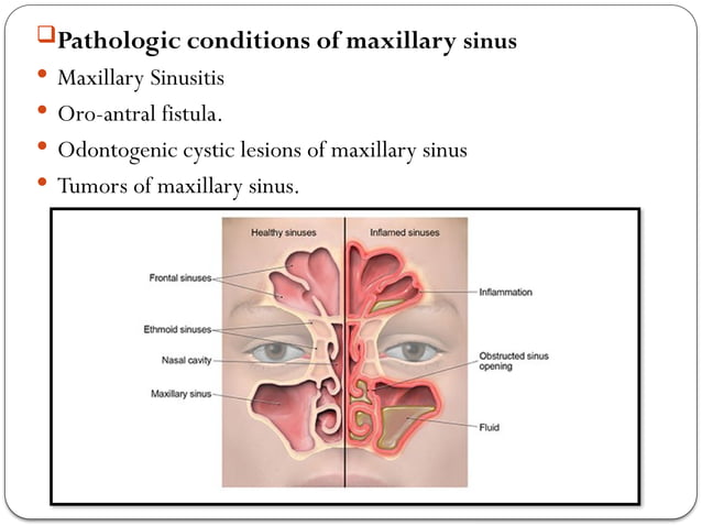 maxillarysinuspresentation-201208183440.pptx