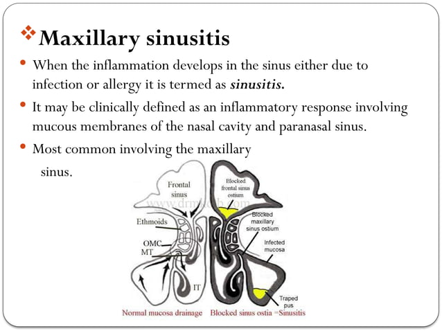 maxillarysinuspresentation-201208183440.pptx