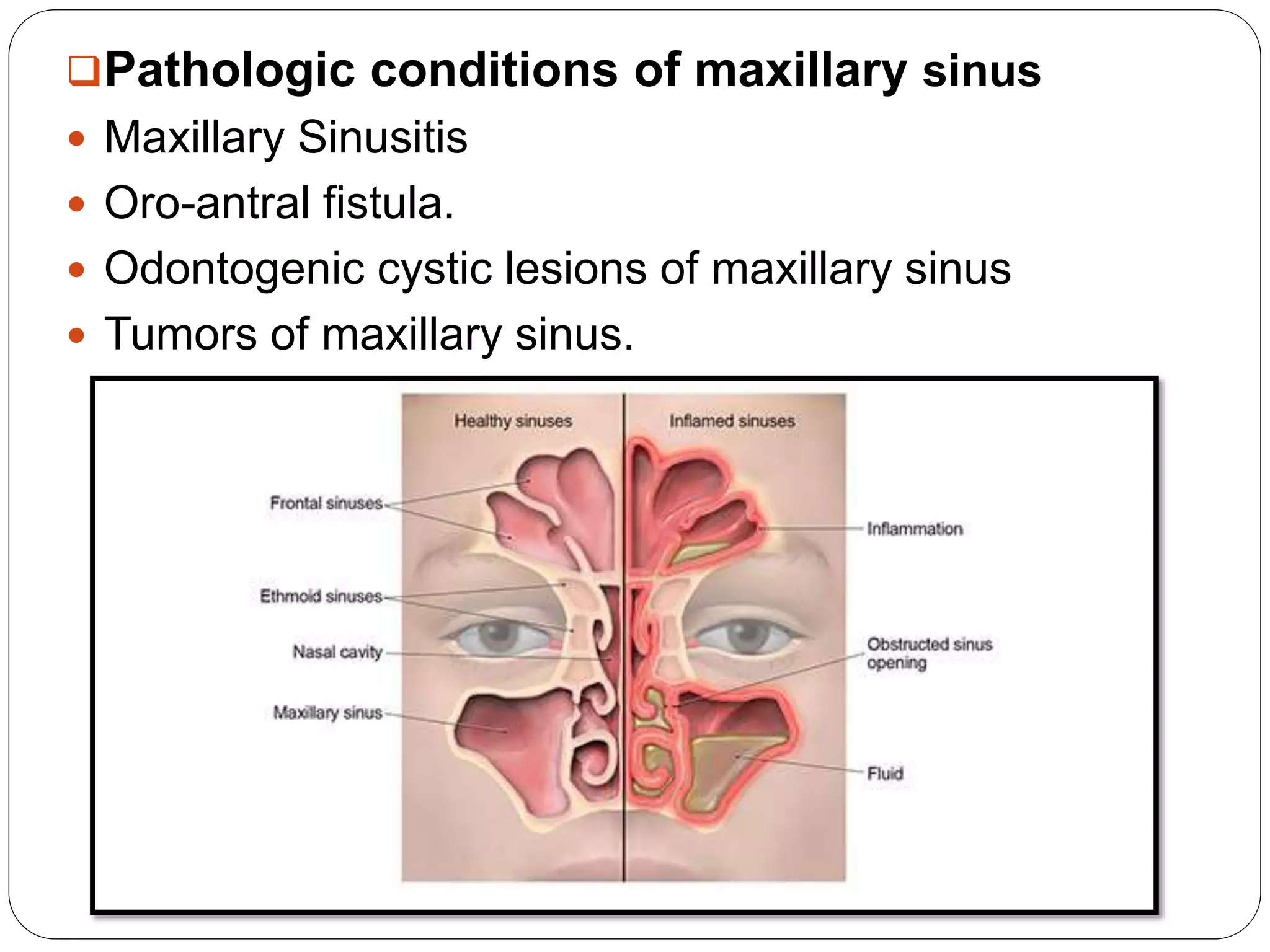 Maxillary sinus presentation | PPTX