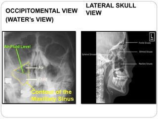 Maxillary sinus presentation | PPTX