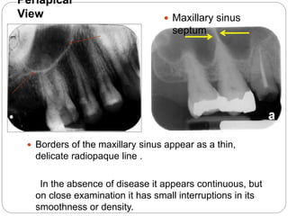 Maxillary sinus presentation | PPTX