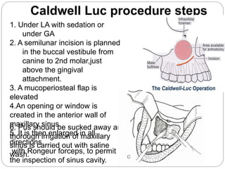 Maxillary sinus presentation | PPT