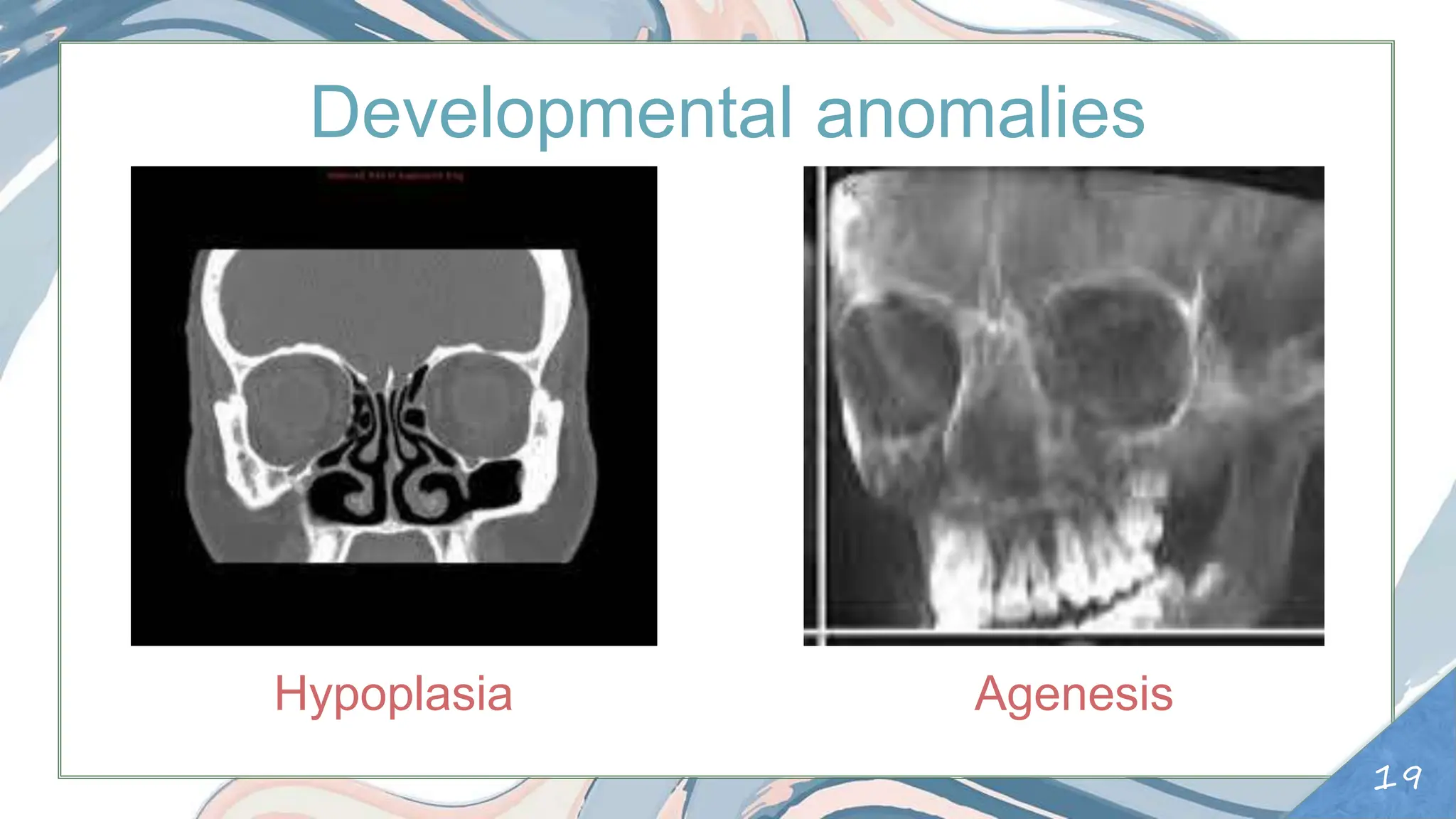 maxillary sinus anatomy histology oralbio | PPTX