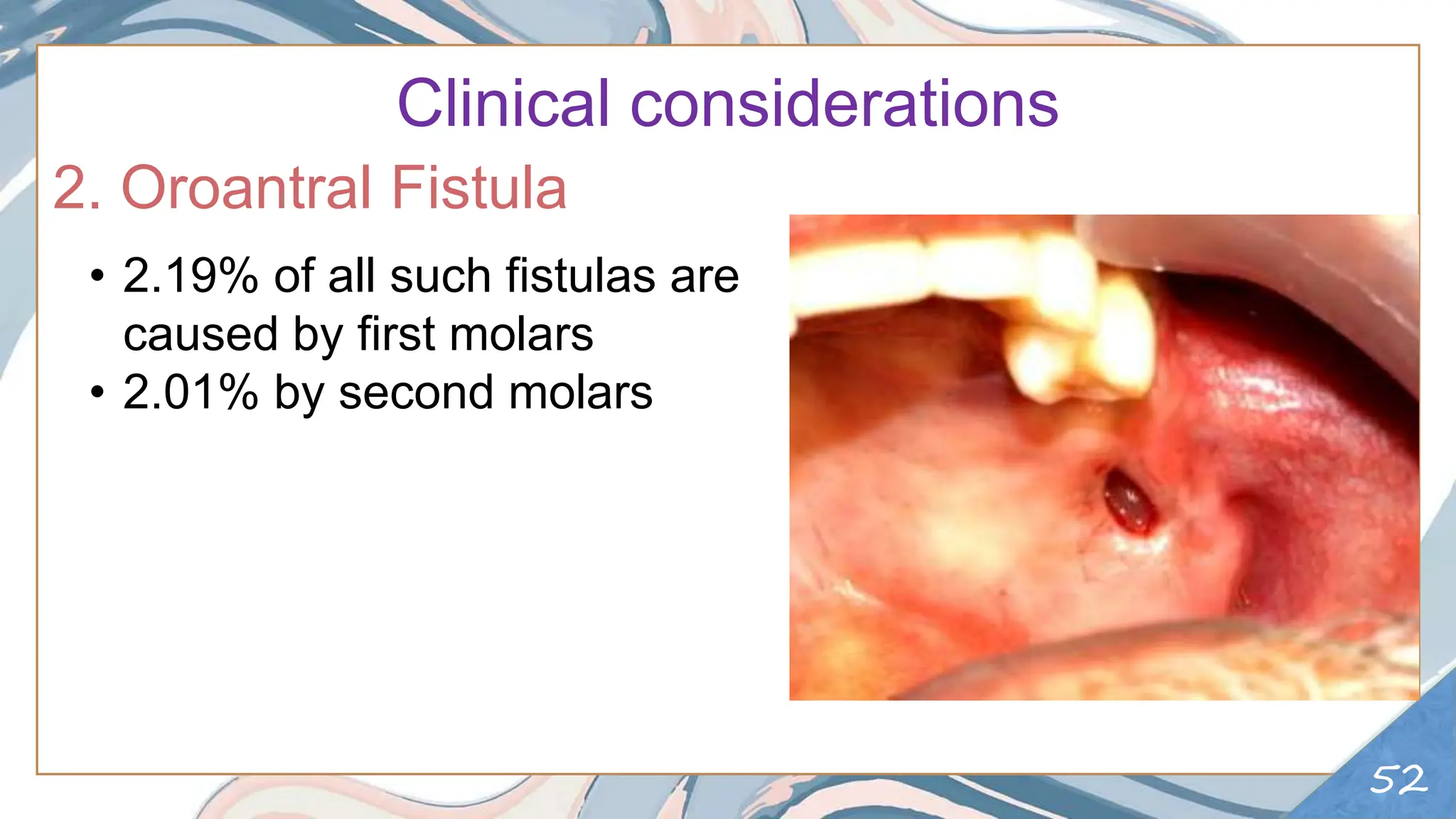 maxillary sinus anatomy histology oralbio | PPTX