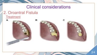 maxillary sinus anatomy histology oralbio | PPTX