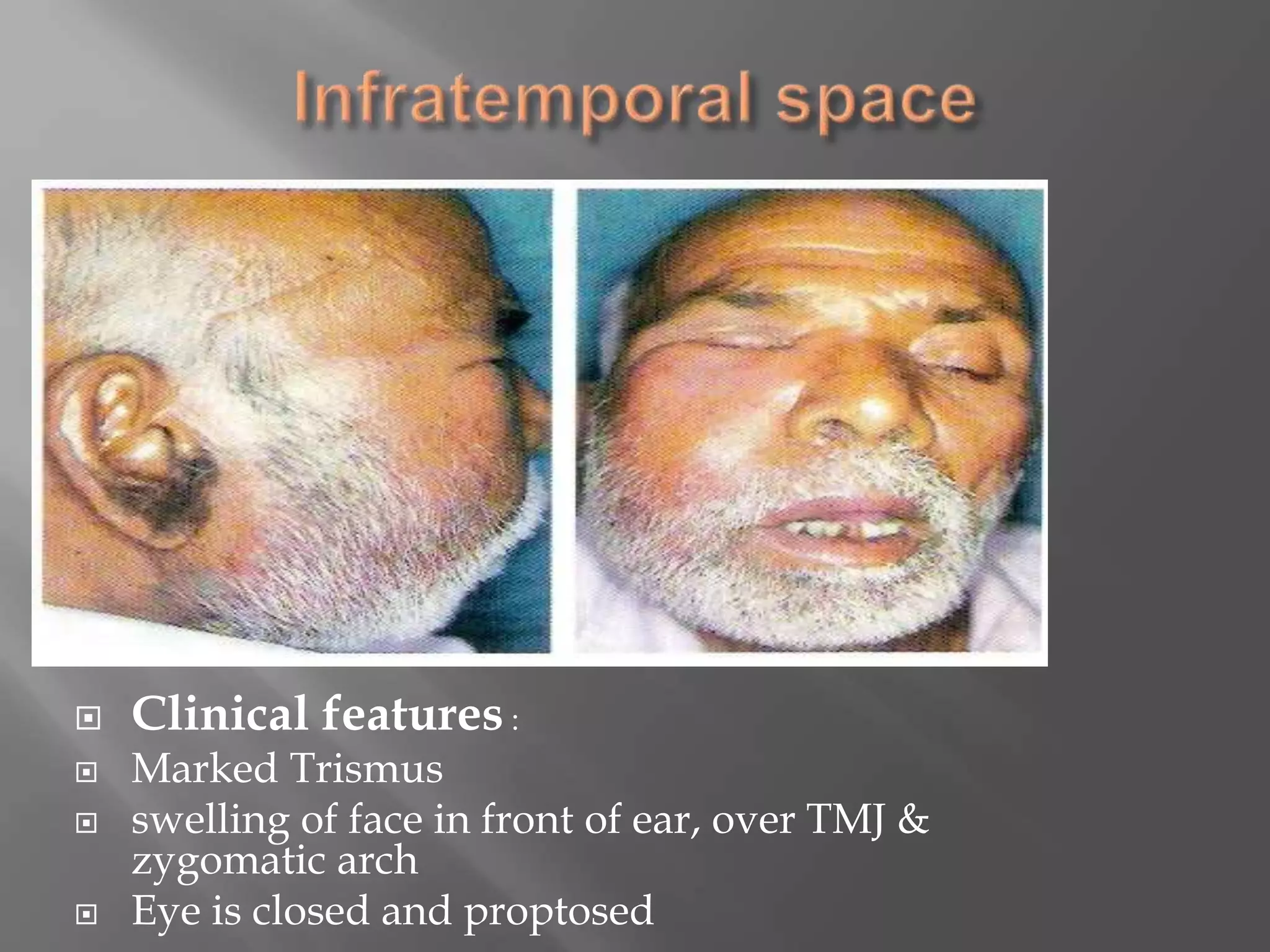 Maxillary space infection | PPTX