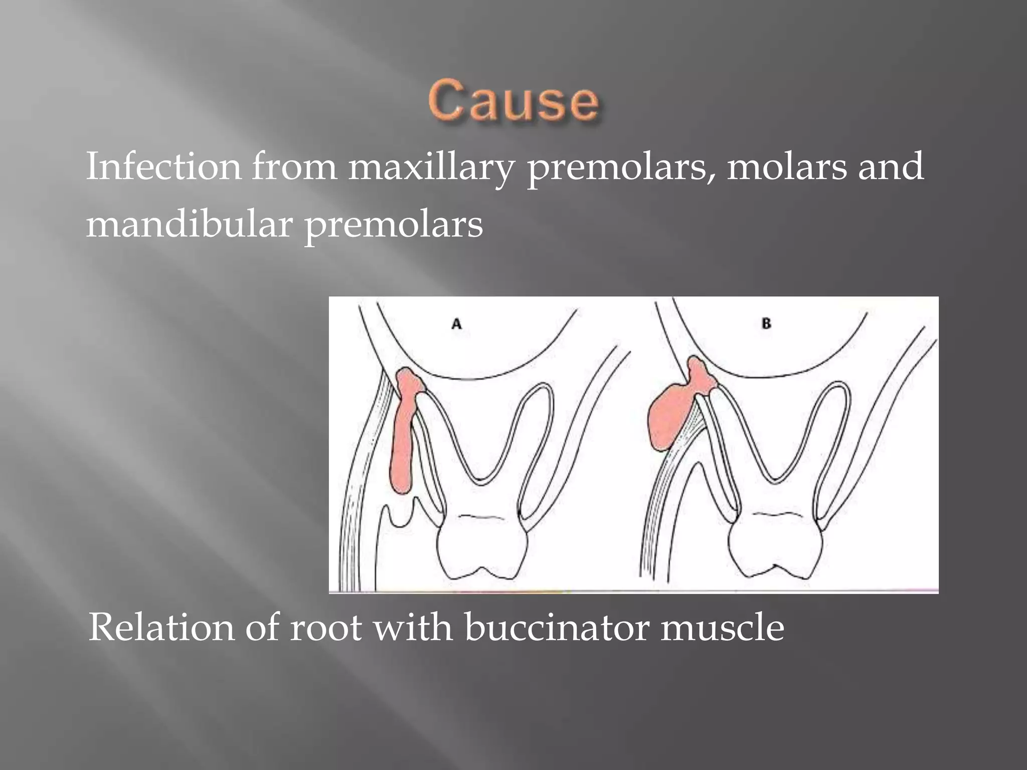 MAXILLARY SPACE INFECTION.pptx