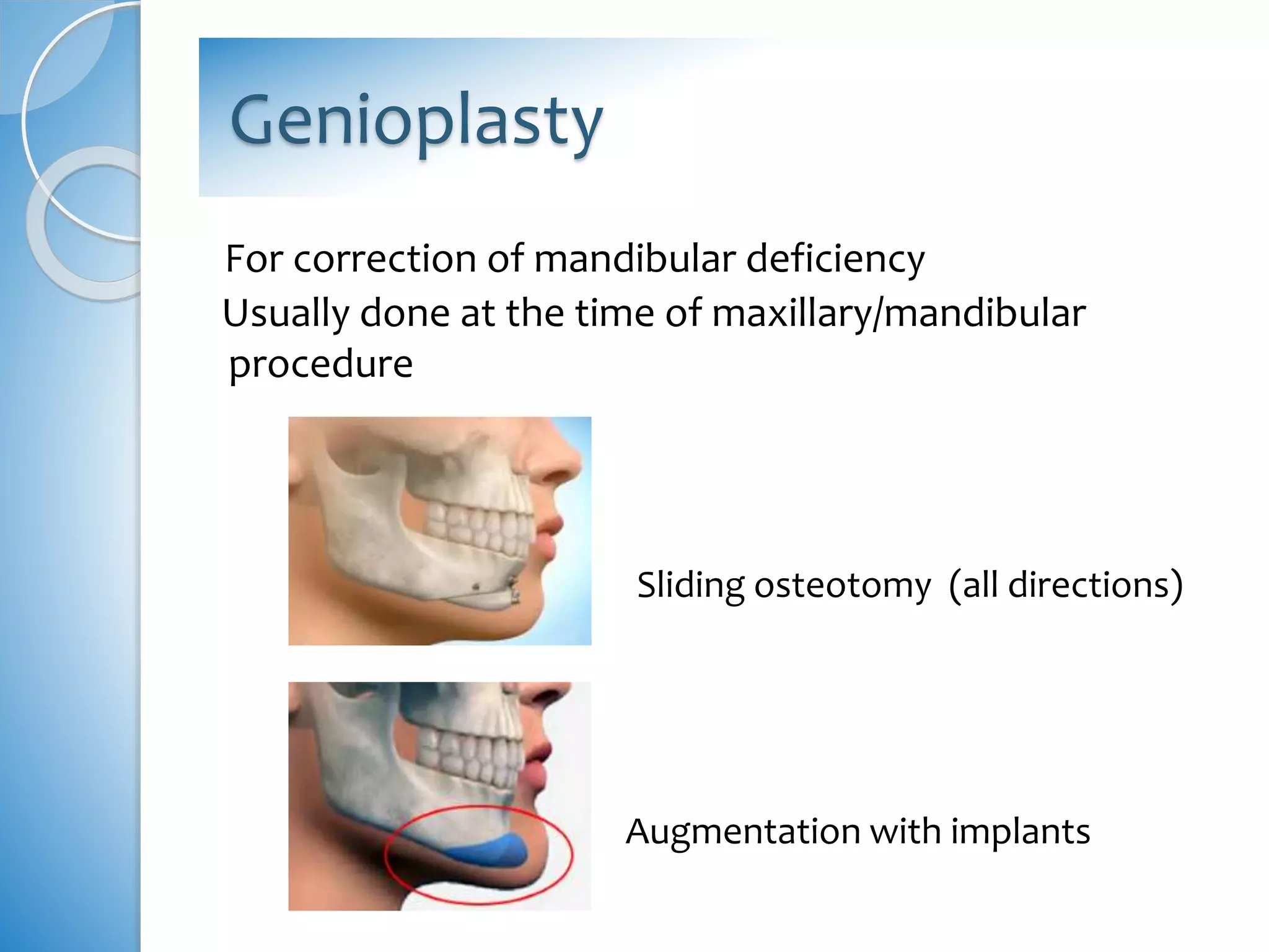 Maxillary surgery | PPTX | Ear, Nose and Throat Conditions | Diseases ...