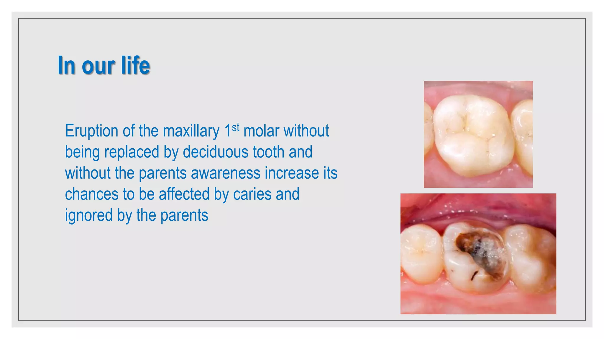 Maxillay first molar | PPTX