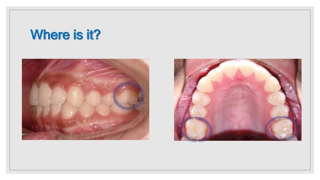 Maxillay First Molar Ppt 2471