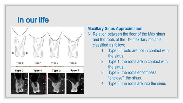 Maxillay First Molar Ppt 0951