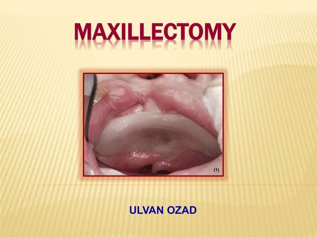Maxillectomy | PPTX