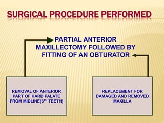 Maxillectomy | PPTX