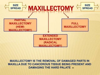 Maxillectomy | PPTX